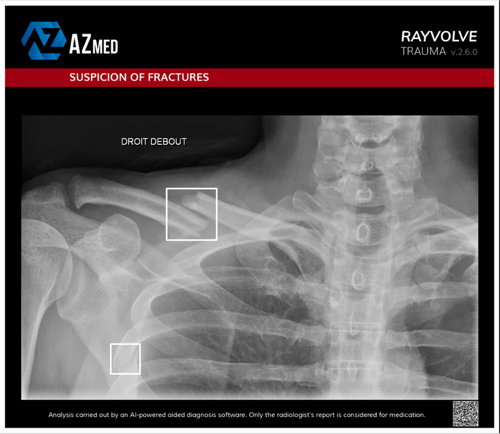 Automatic Fracture Detection | Rayvolve for Trauma