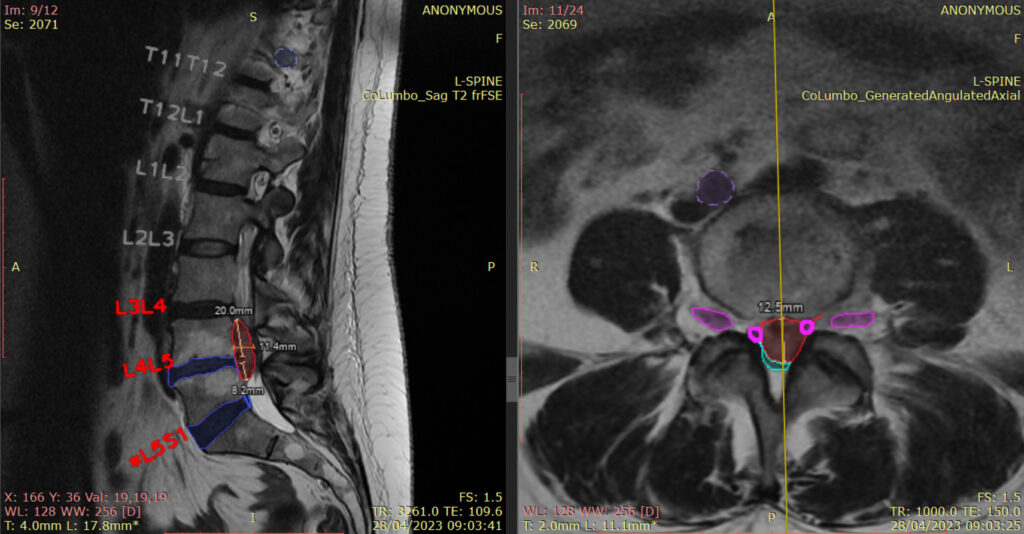Lumbar Spine MRI Analysis | CoLumbo