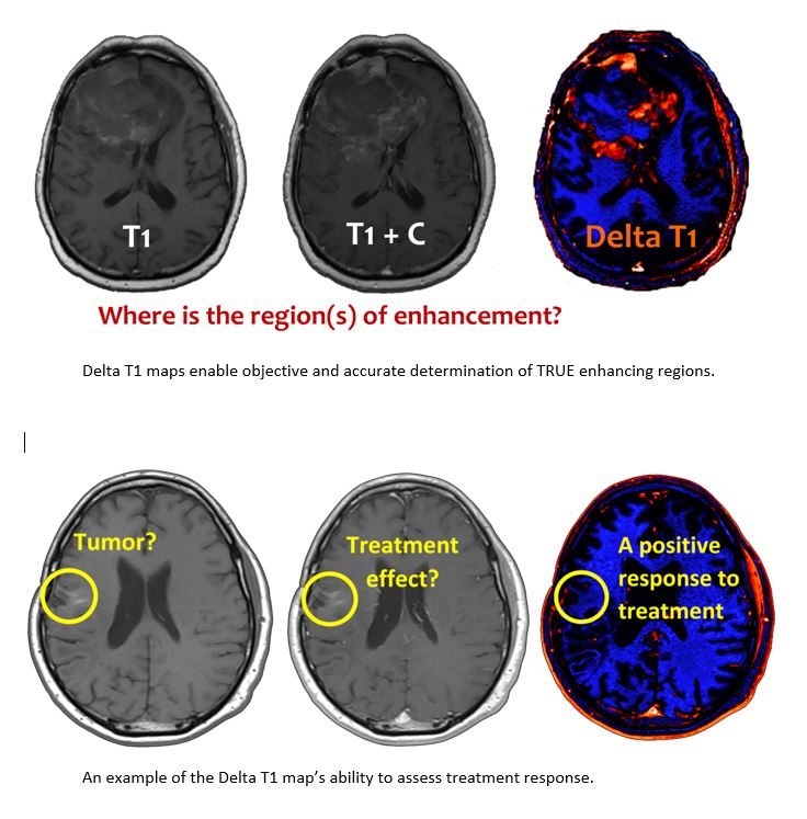 Comparison of T1 And T1+C Images | IB Delta T1 Maps