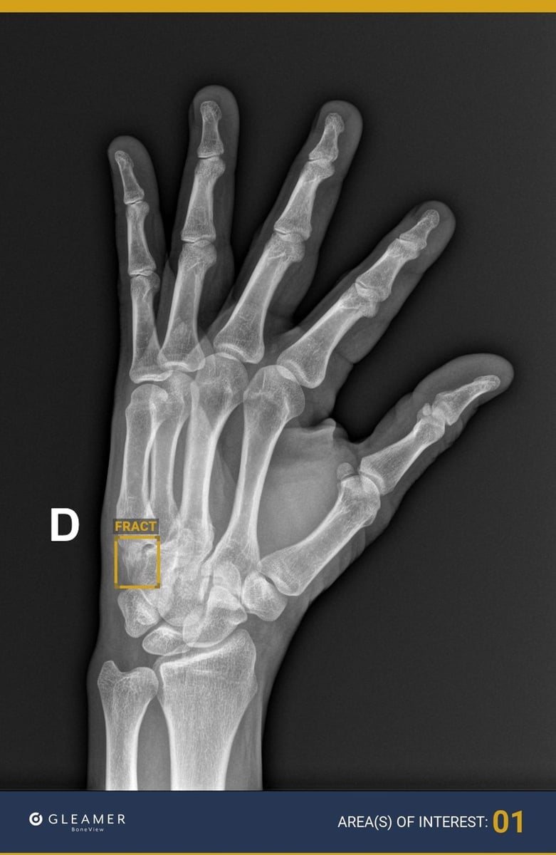 Fracture detection | BoneView