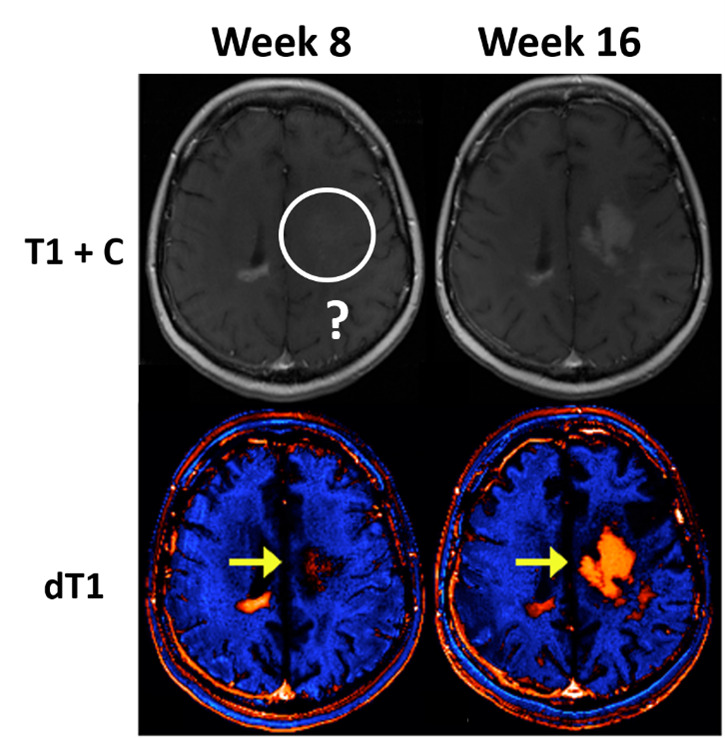 Comparison of T1 And T1+C Images | IB Delta T1 Maps