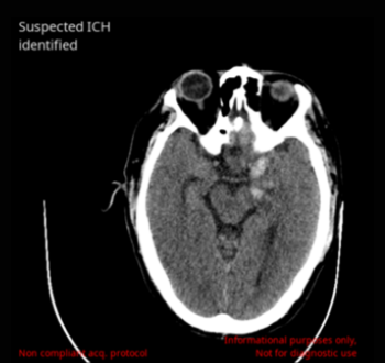 ICH Detection and Prioritization | CINA Head - ICH