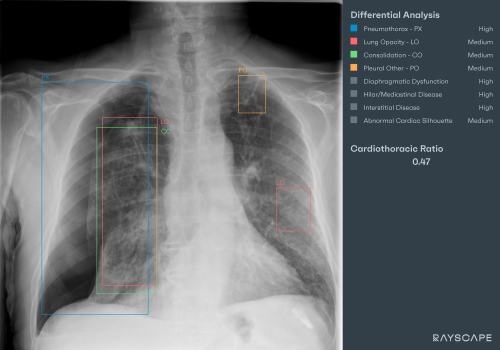Lung Cancer Detection | Rayscape CXR