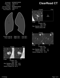 Pulmonary Nodule Detection | ClearRead CT