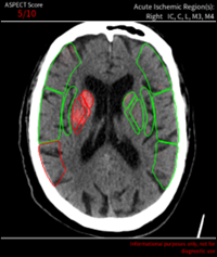 Automatic ASPECT Scoring | CINA Head - ASPECTS
