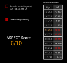 Automatic ASPECT Scoring | CINA Head - ASPECTS