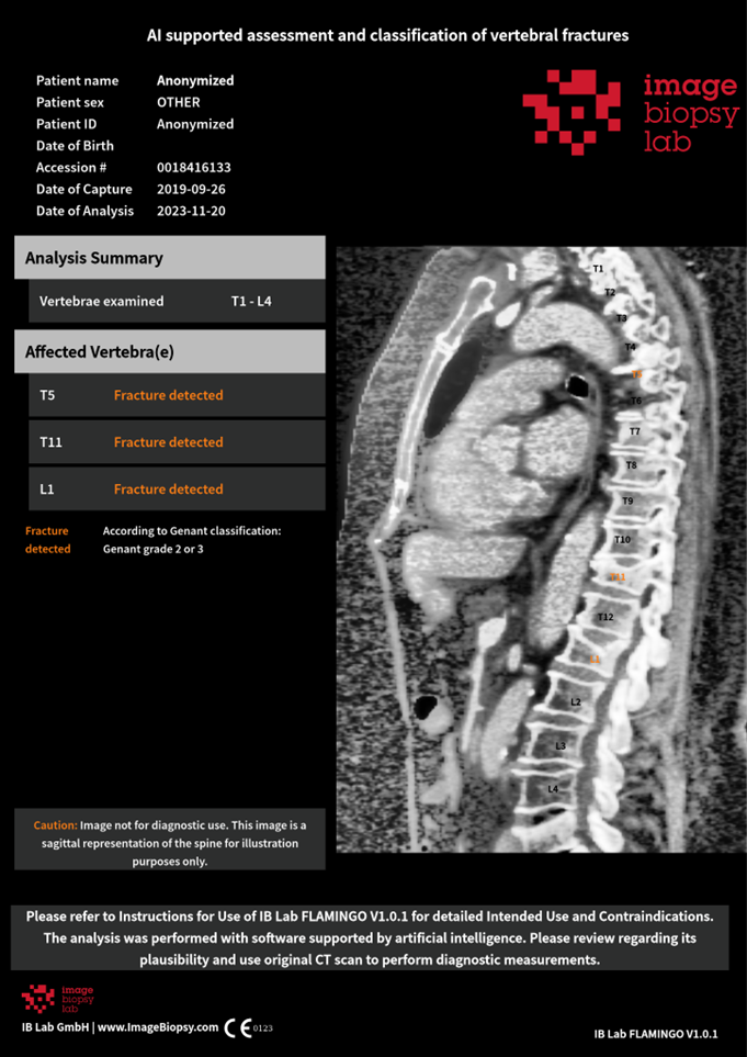 Opportunistic Detection of Vertebral Fracture – IB Lab FLAMINGO