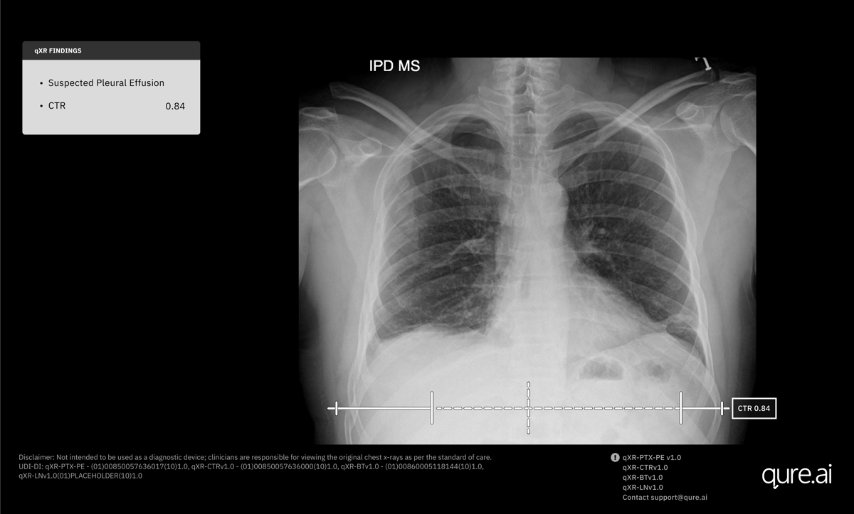 Chest Xray interpretation | qXR